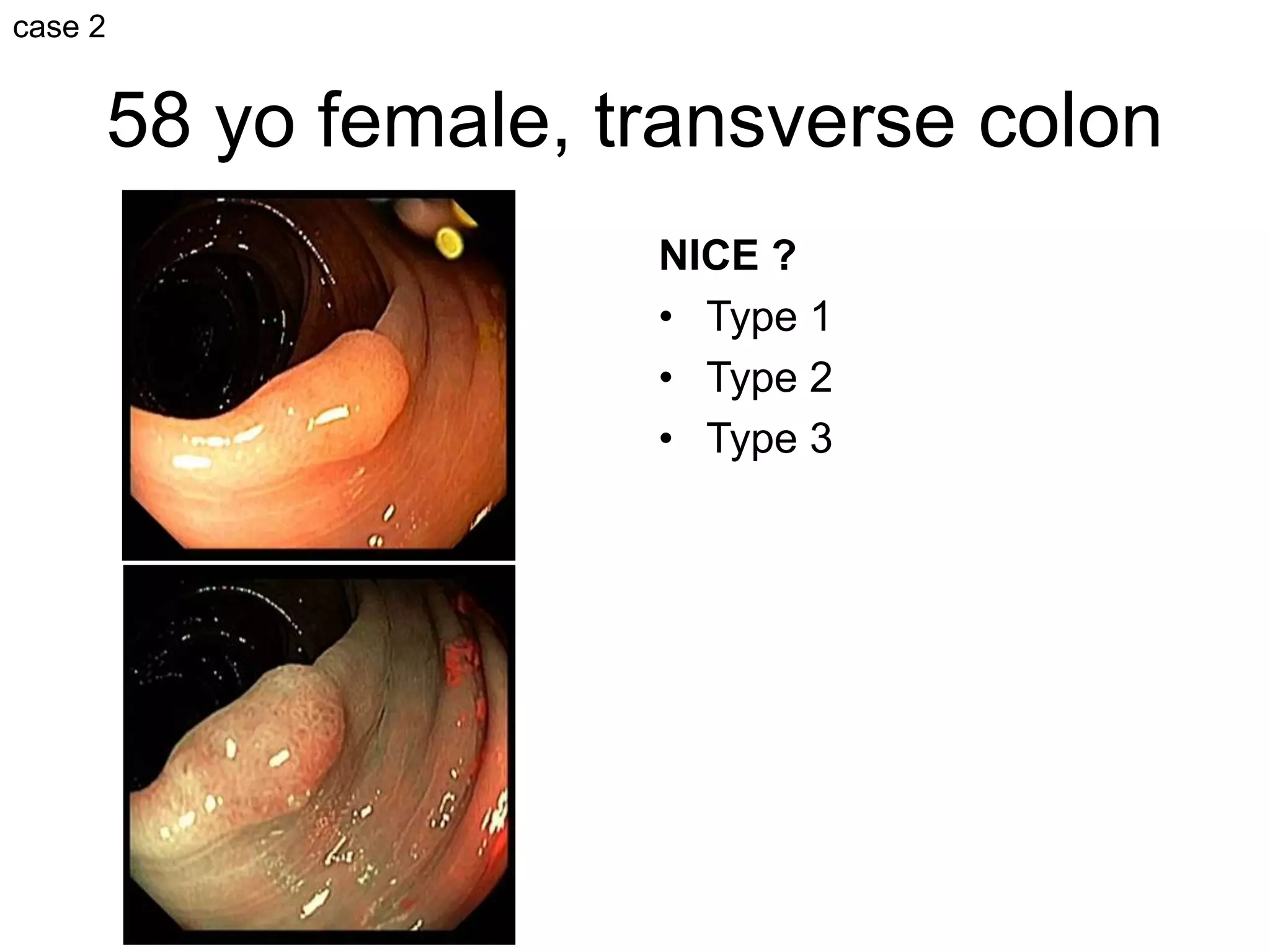 Portfolio of colonic polyps | PPSX