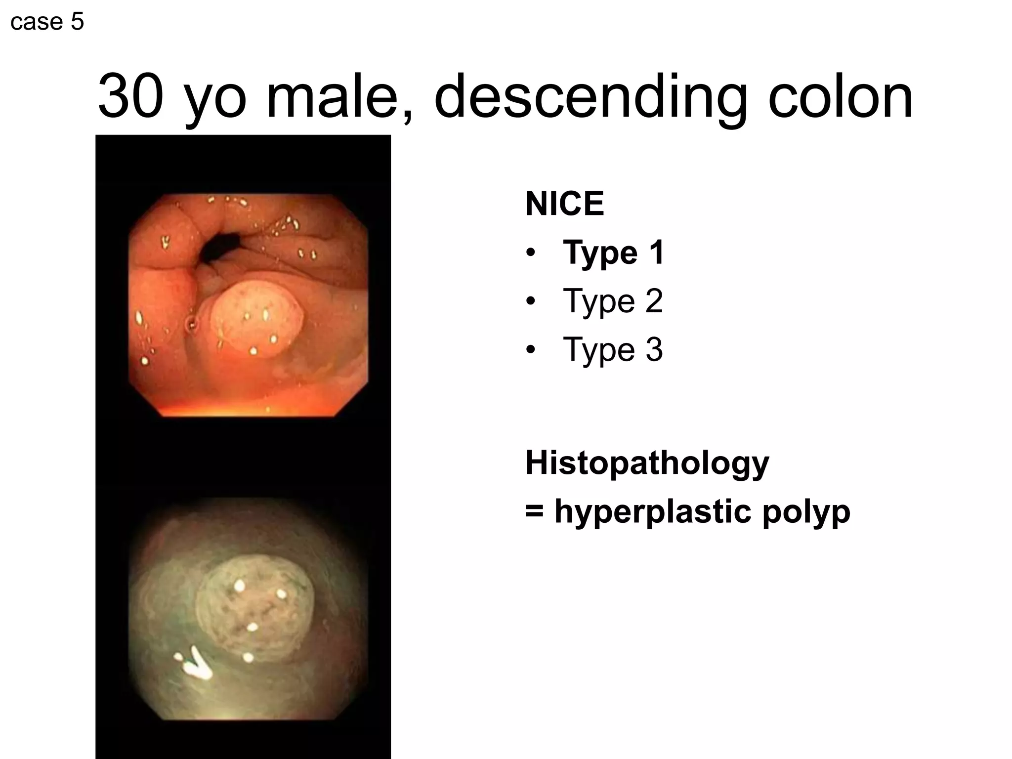 Portfolio of colonic polyps | PPSX