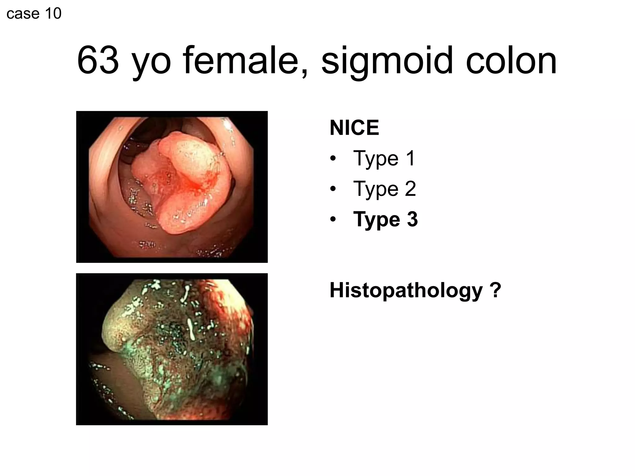 Portfolio of colonic polyps | PPSX