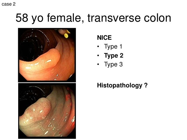 Portfolio of colonic polyps