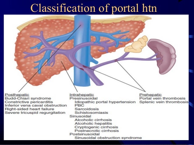 portal hypertension..classification and pathophysiology.