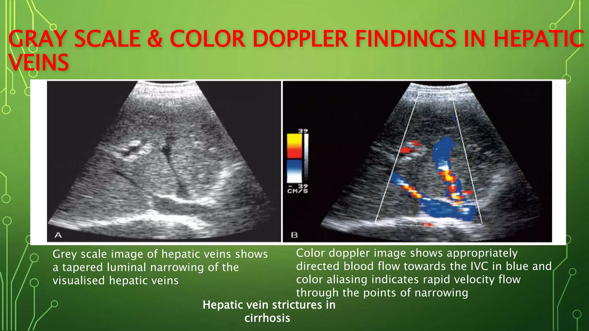 Imaging in Portal hypertension | PPTX