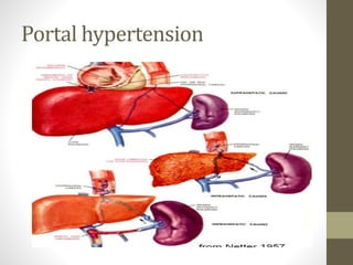 Portocaval anastamosis | PPTX