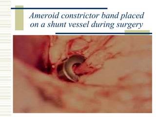 Portosystemic shunt | PPT