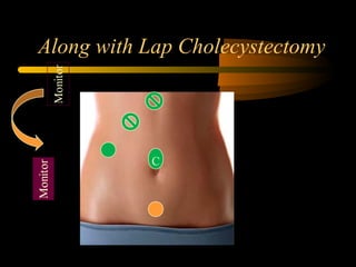 Port position for lap apppendix and ergonomics | PPT