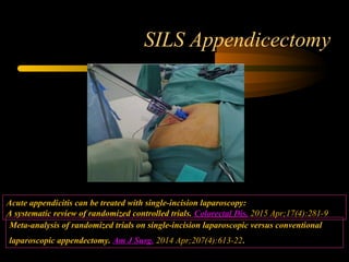 Laparoscopic Appendectomy Port Placement