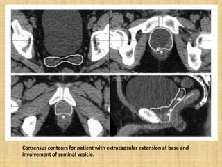 Post Operative RT in Carcinoma prostate | PPTX