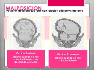 Posición anormal del feto | PPTX