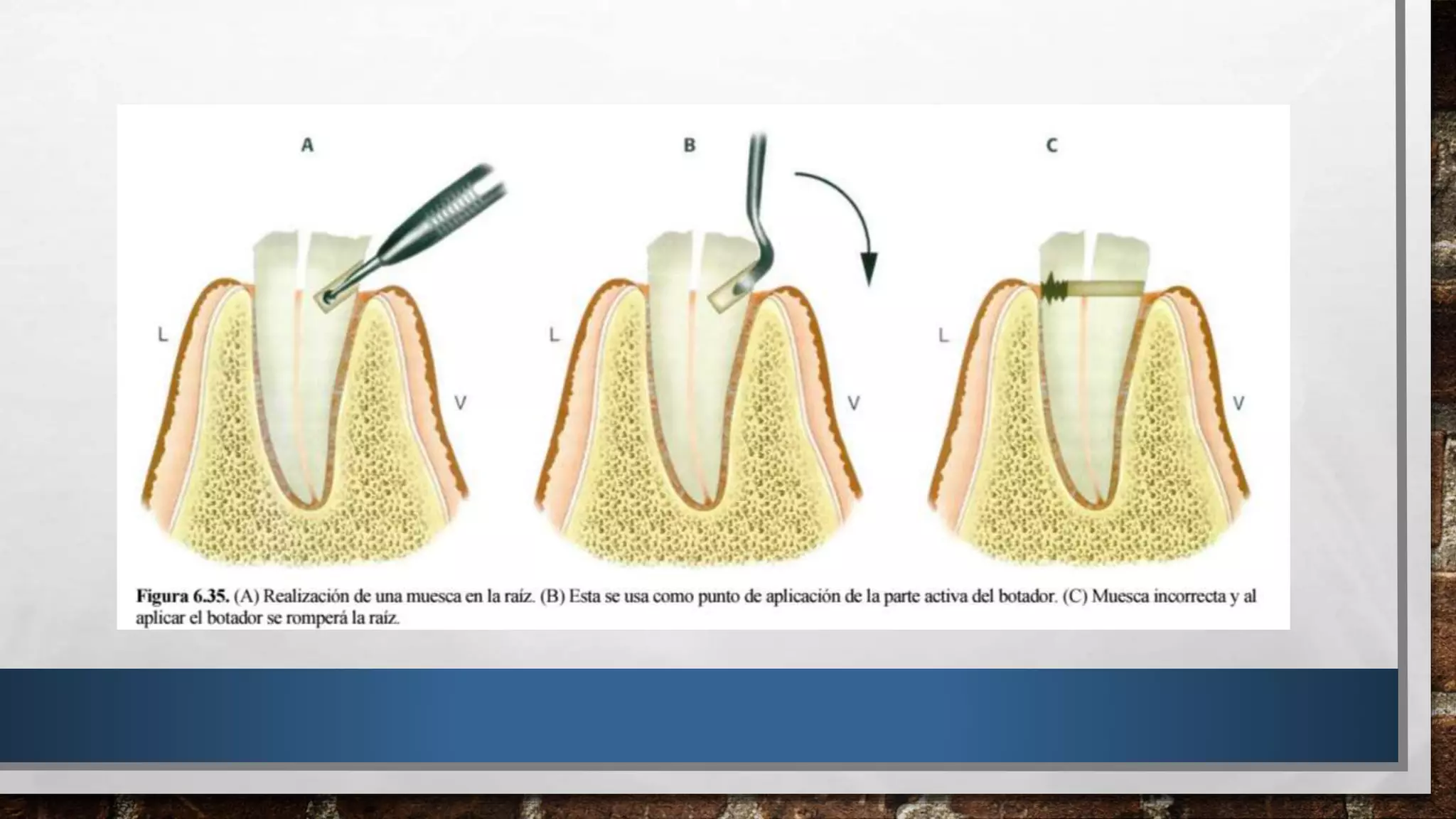 POSICIONES TIEMPOS Y TÉCNICAS PARA EXTRACCIÓN DENTAL | PPTX