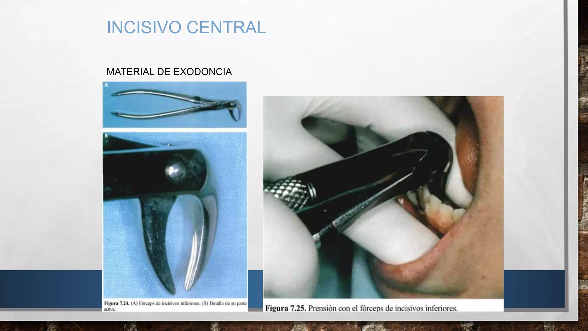 POSICIONES TIEMPOS Y TÉCNICAS PARA EXTRACCIÓN DENTAL | PPTX