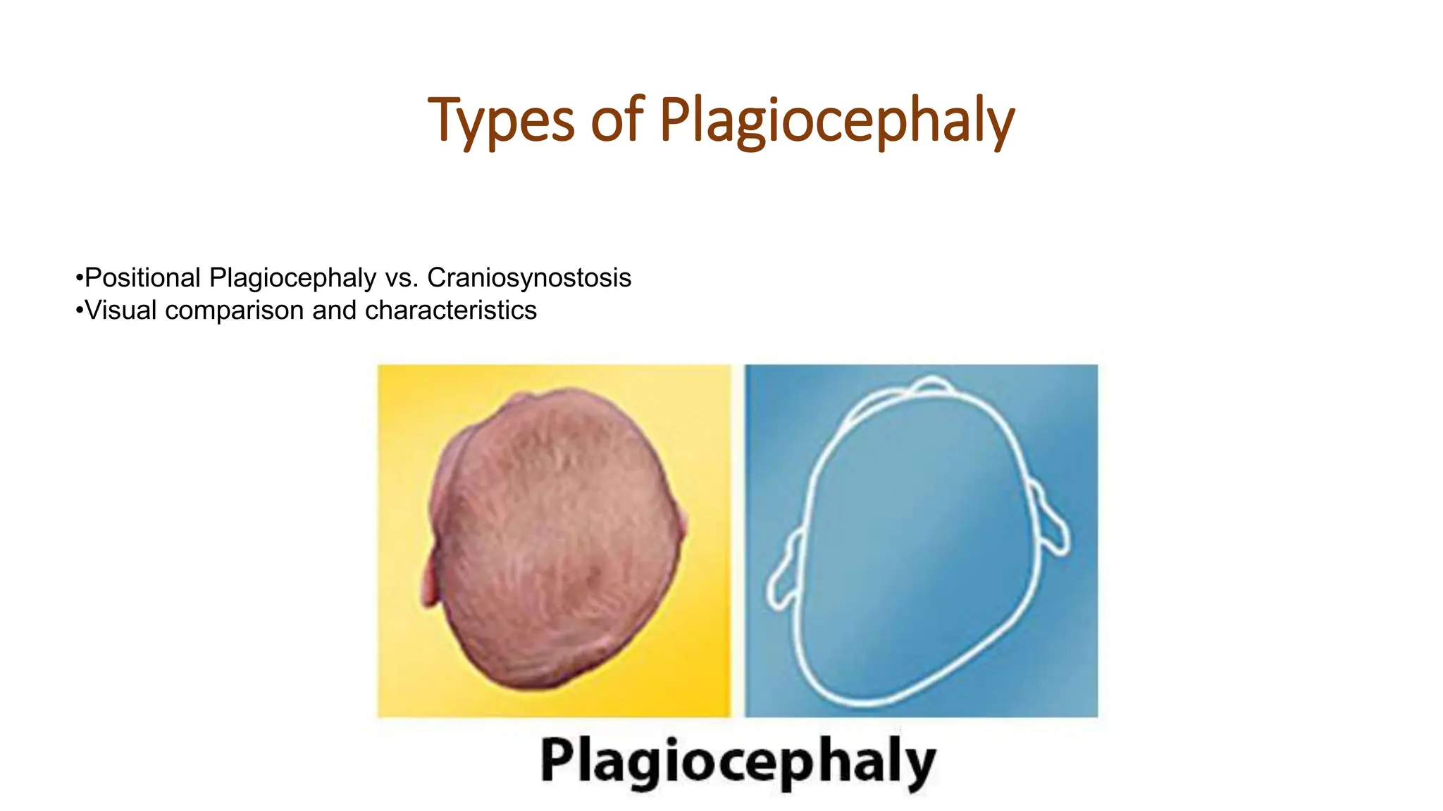 Effective Treatment Solutions for Positional Plagiocephaly | PPTX