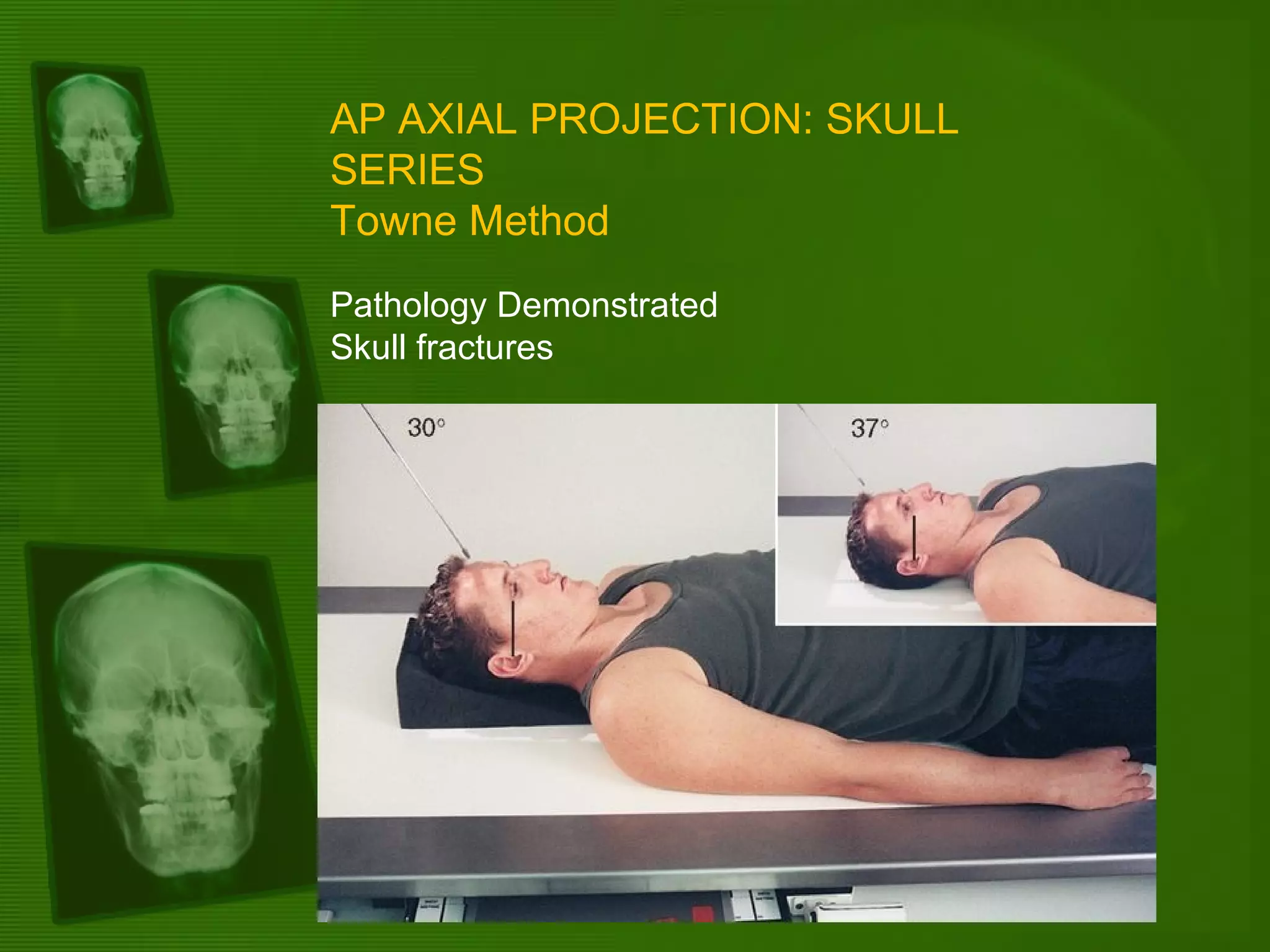 Positioning and radiographic anatomy of the skull | PPT