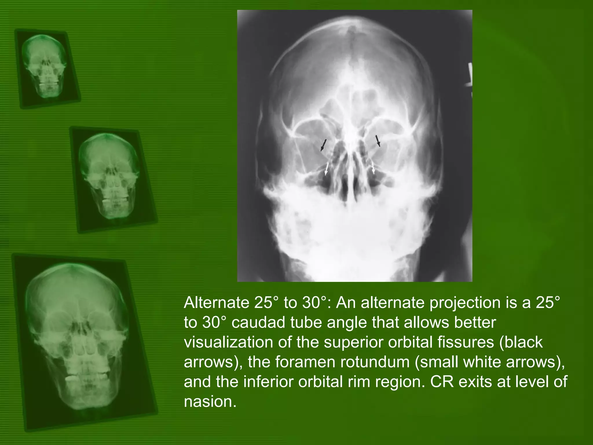 Positioning and radiographic anatomy of the skull | PPT