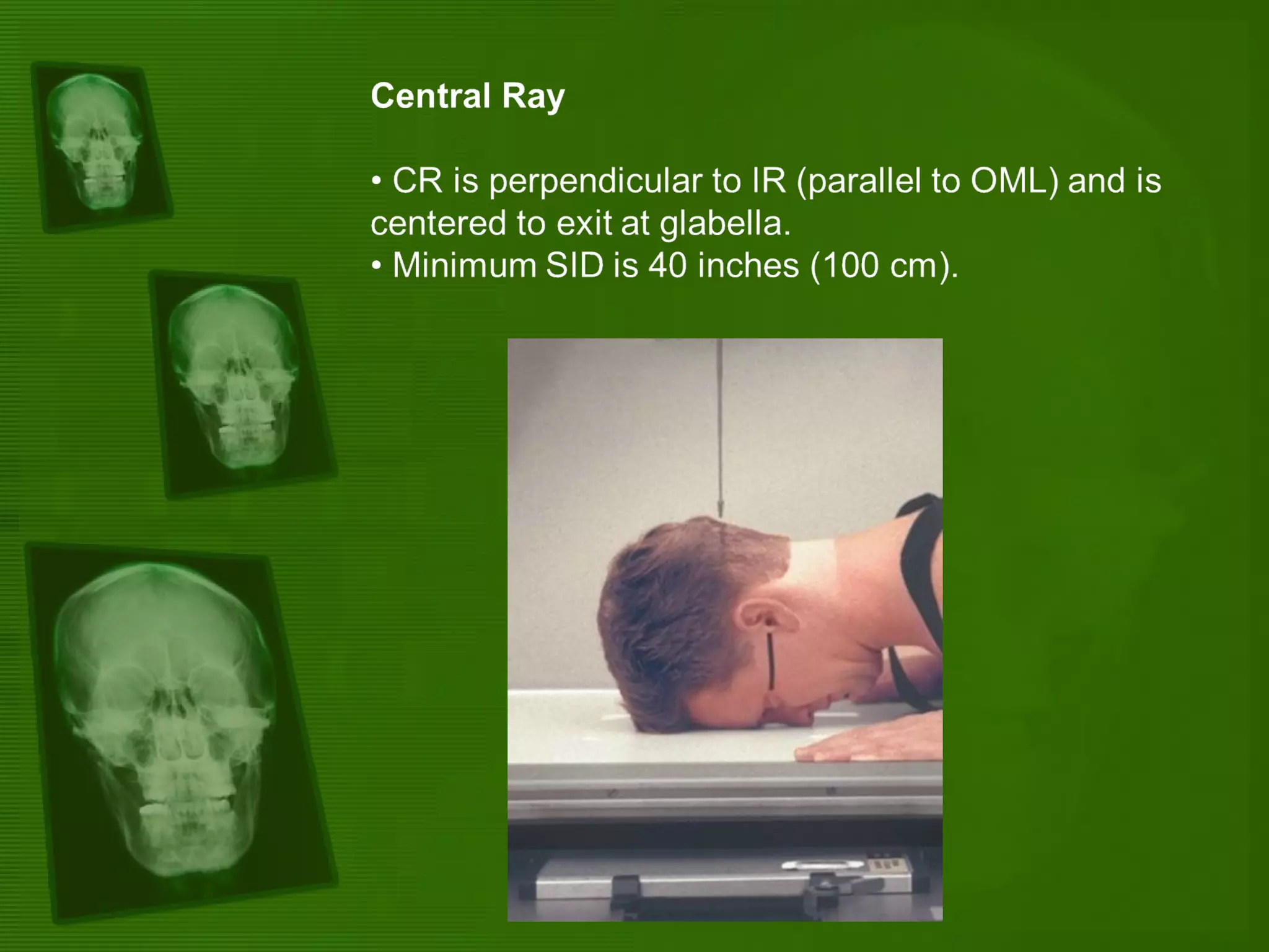 Positioning and radiographic anatomy of the skull | PPT