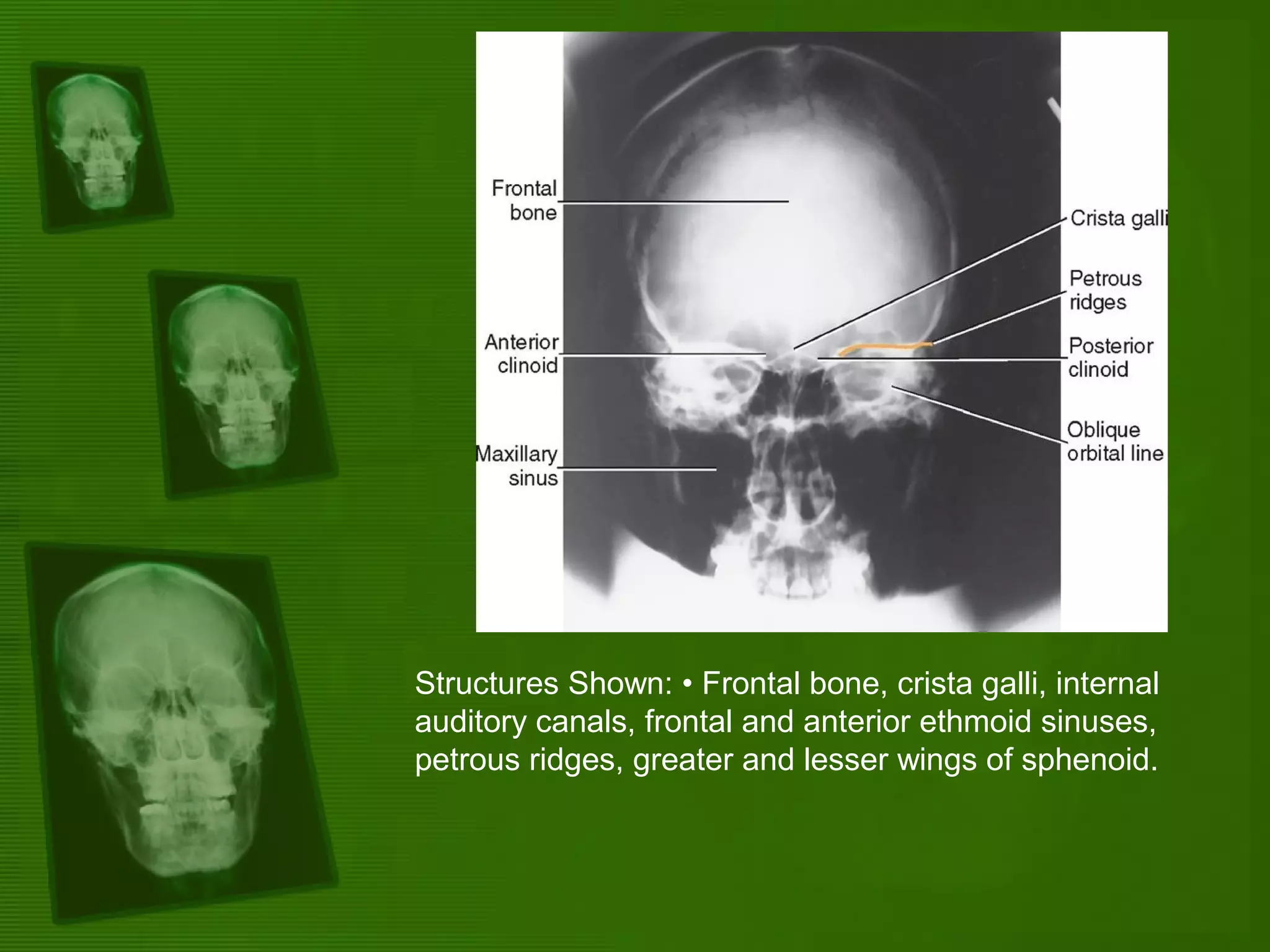 Positioning And Radiographic Anatomy Of The Skull Ppt