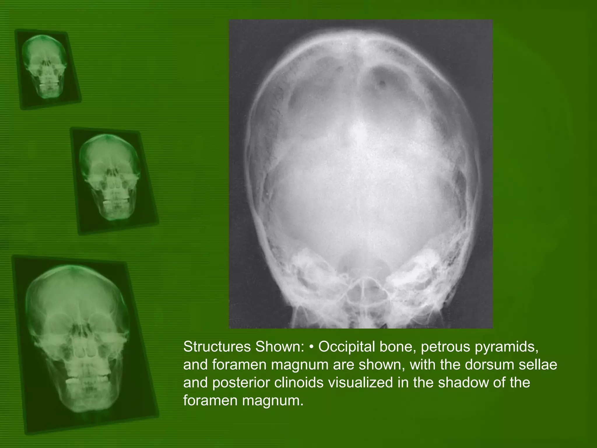 Positioning and radiographic anatomy of the skull | PPT | Bone and ...