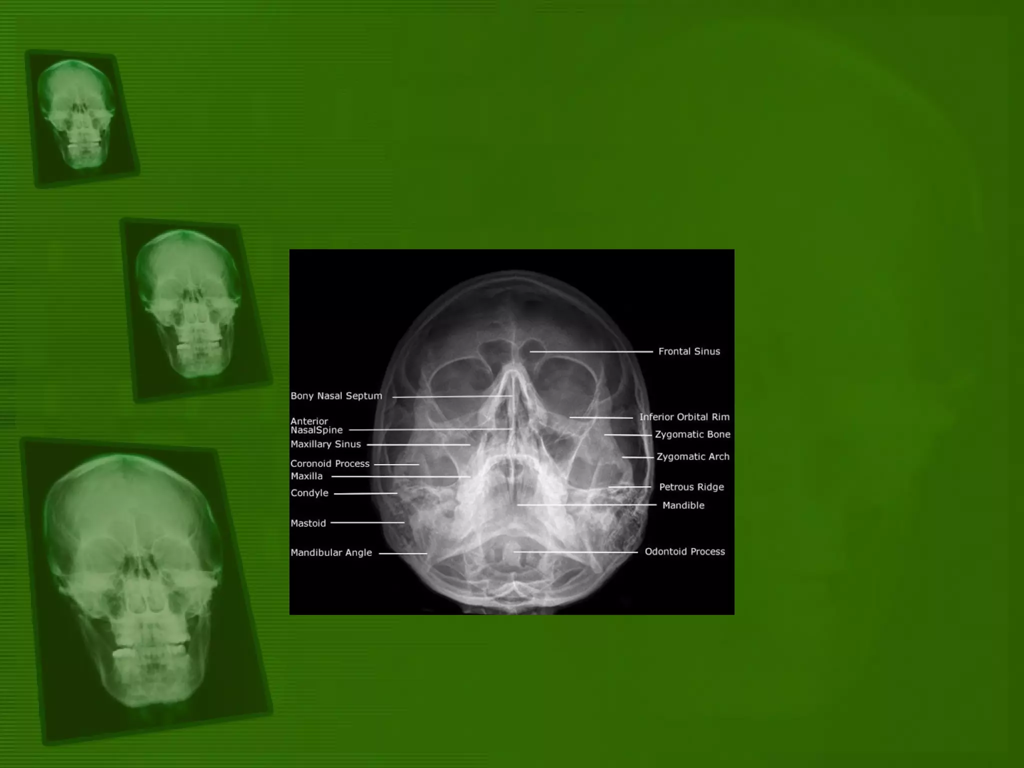 Positioning and radiographic anatomy of the skull | PPT | Bone and ...
