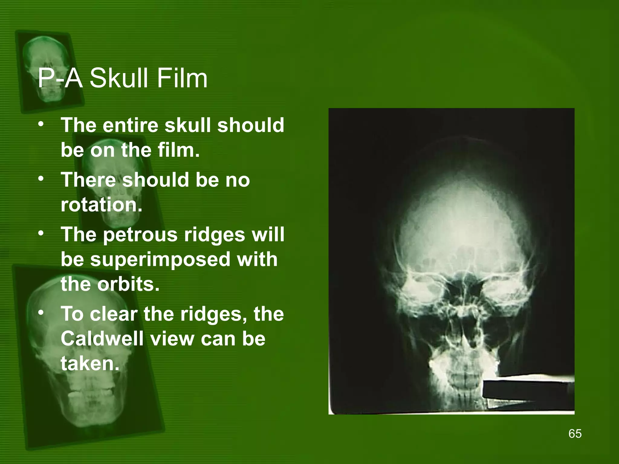 Positioning and radiographic anatomy of the skull | PPT