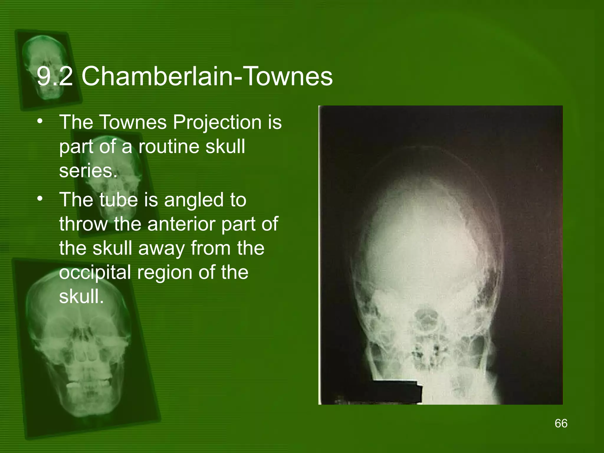Positioning and radiographic anatomy of the skull | PPT