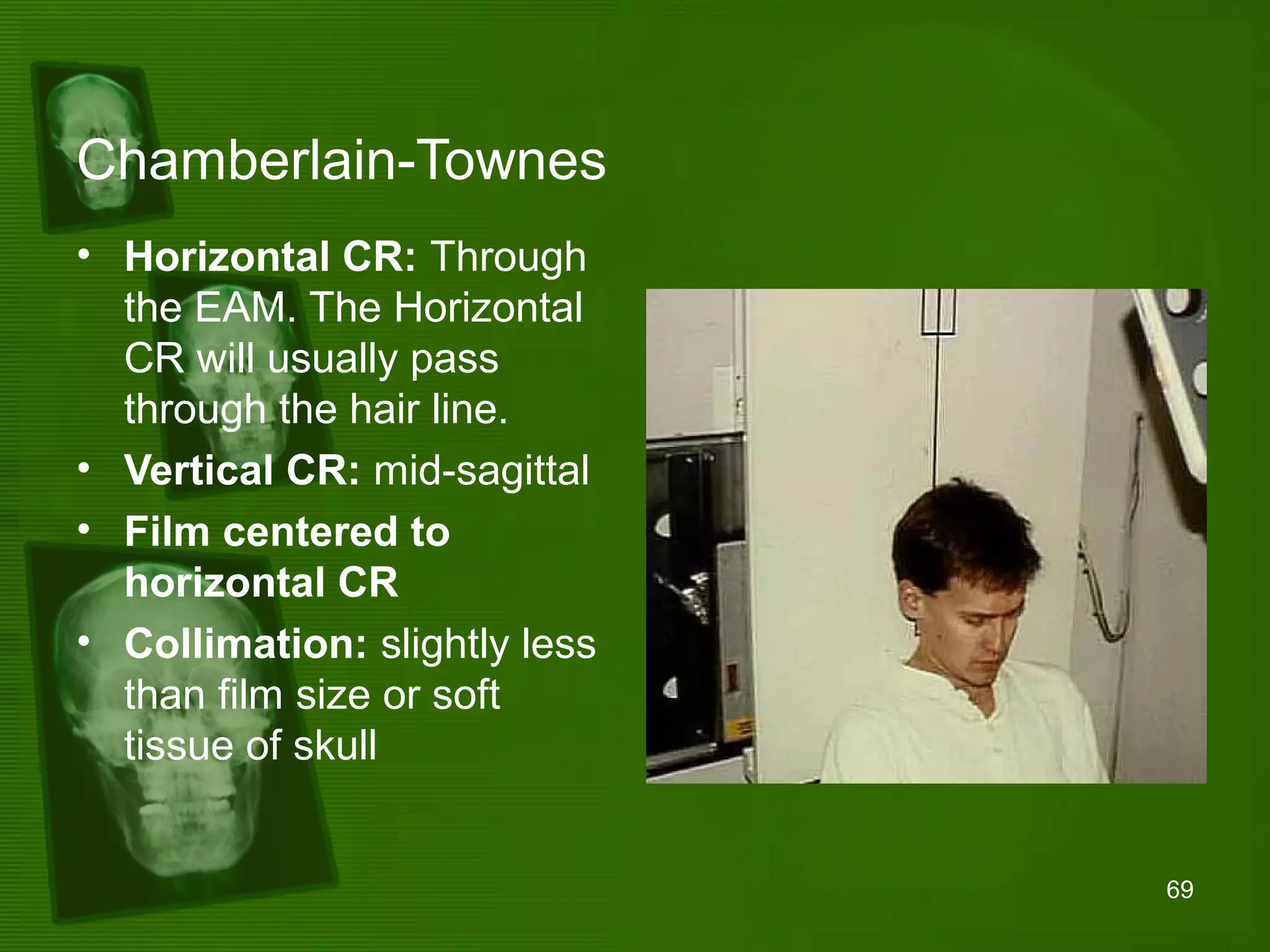 Positioning and radiographic anatomy of the skull | PPT