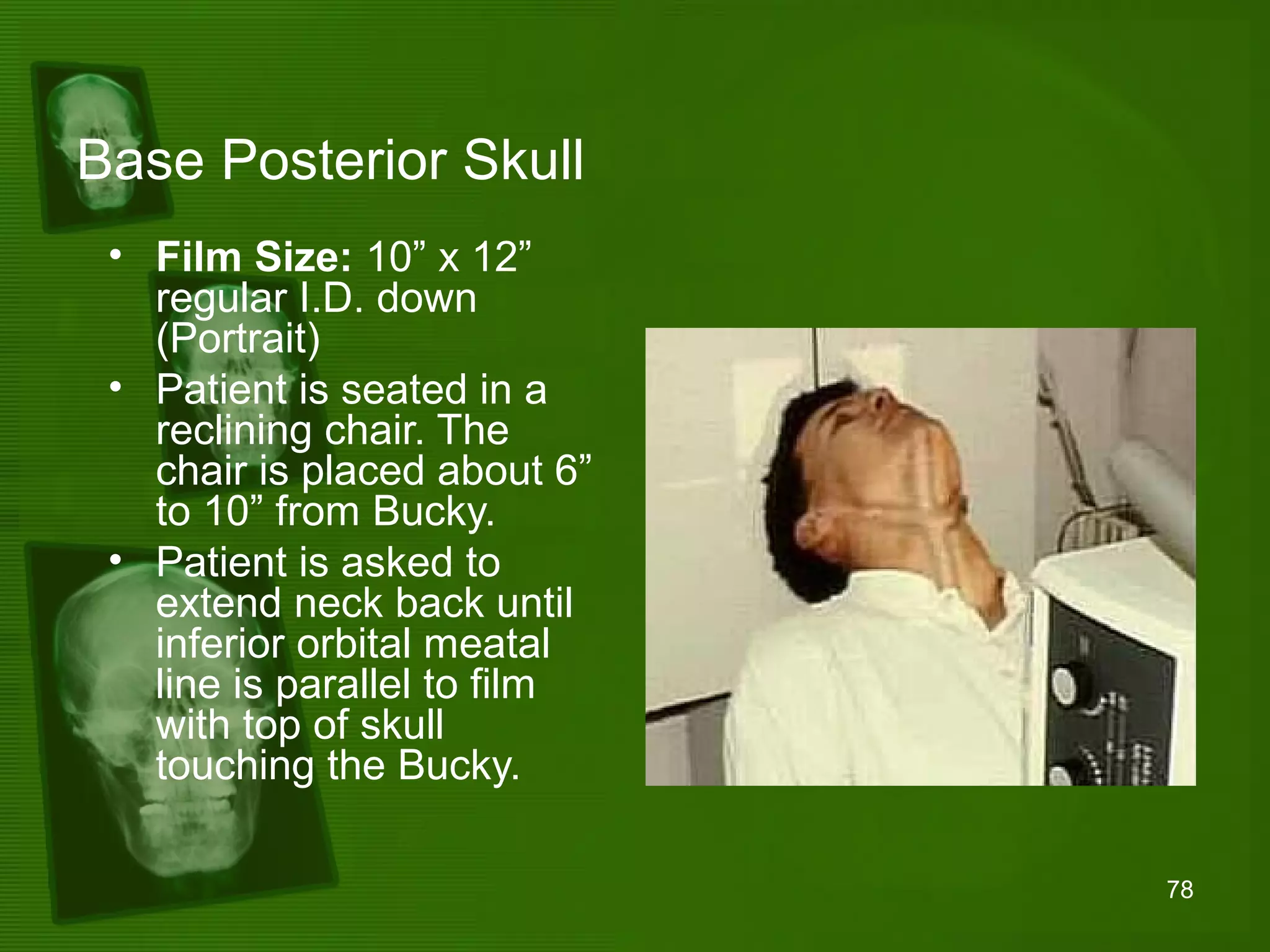 Positioning and radiographic anatomy of the skull | PPT