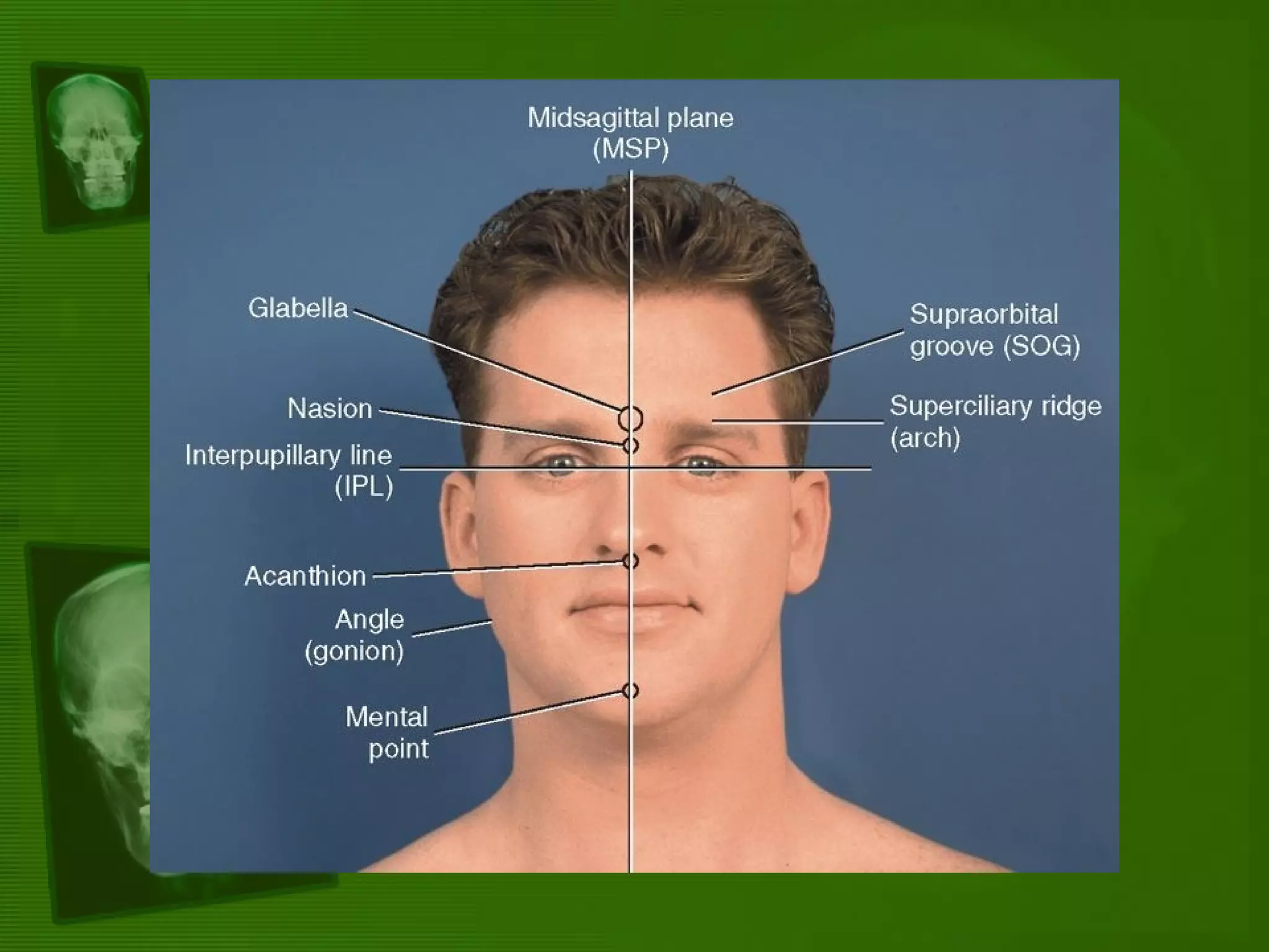 Positioning and radiographic anatomy of the skull | PPT