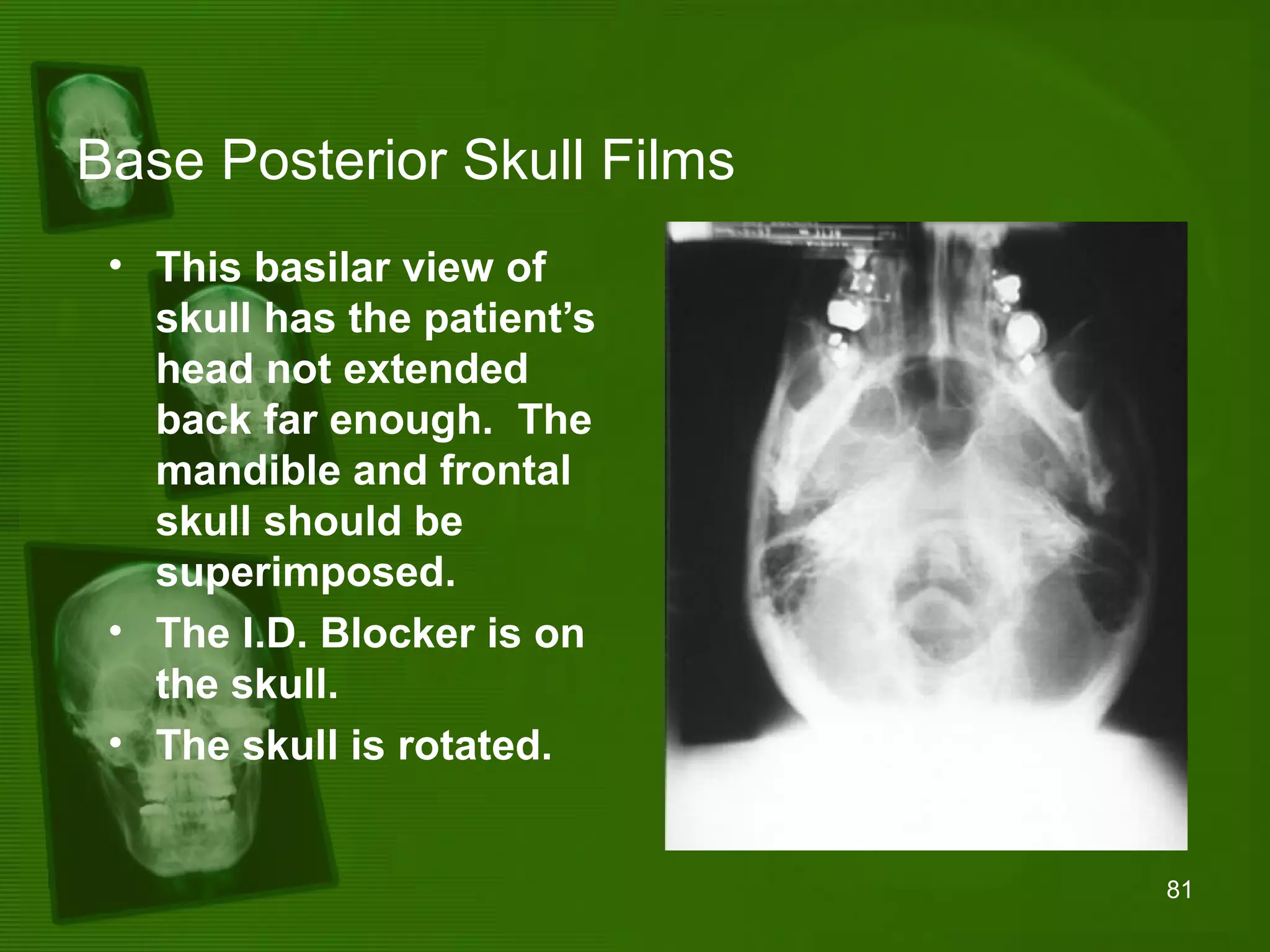 Positioning and radiographic anatomy of the skull | PPT