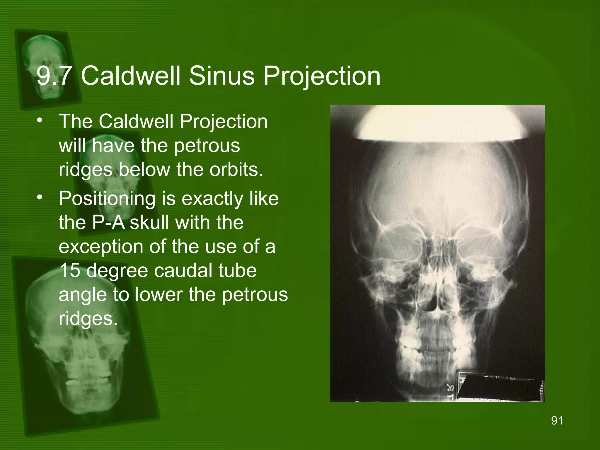 Positioning and radiographic anatomy of the skull | PPT