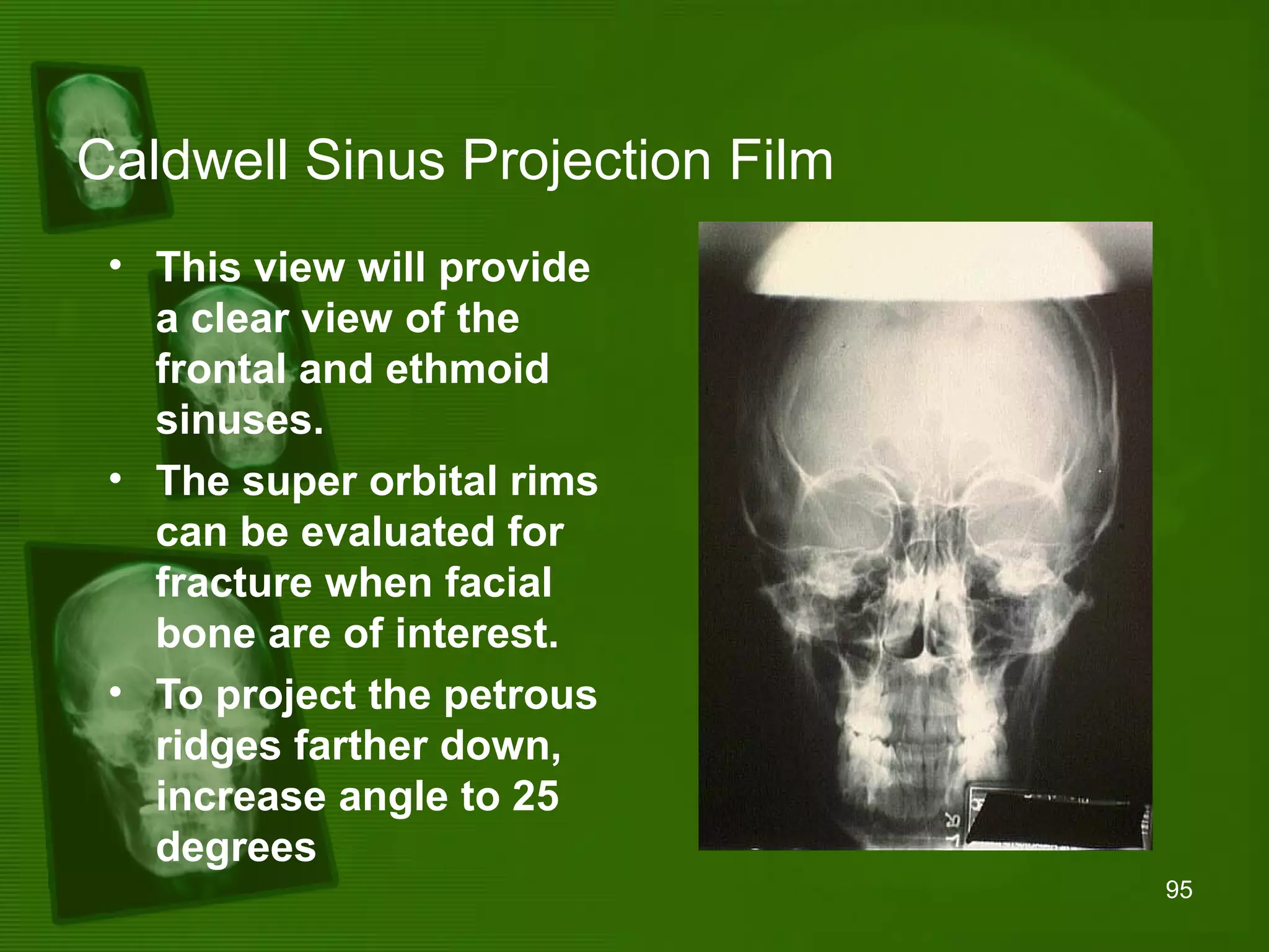 Positioning and radiographic anatomy of the skull | PPT