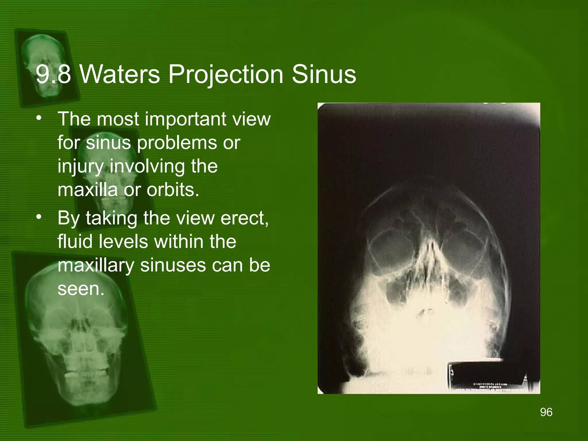 Positioning and radiographic anatomy of the skull | PPT