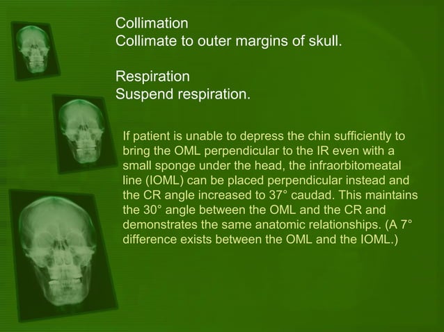 Positioning and radiographic anatomy of the skull | PPT | Bone and ...