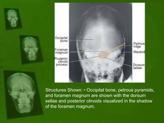 Positioning and radiographic anatomy of the skull | PPT