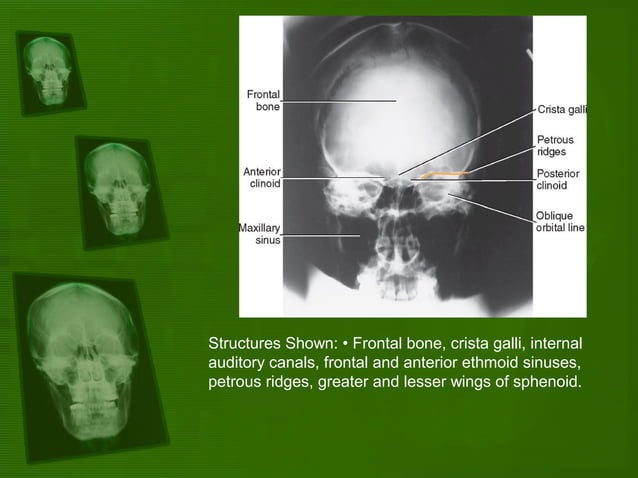 Positioning and radiographic anatomy of the skull | PPT | Bone and ...