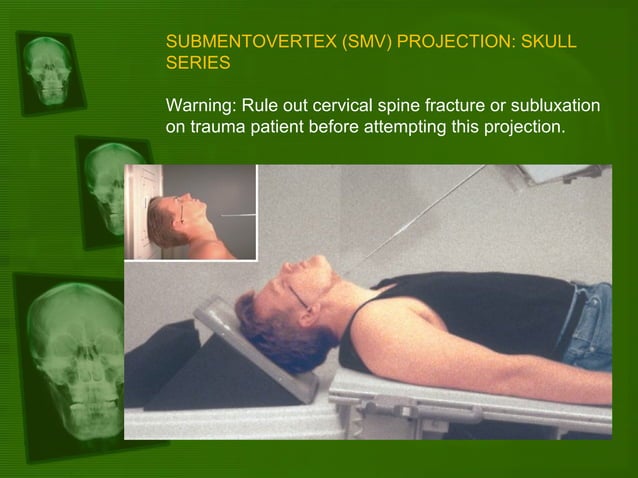 Positioning and radiographic anatomy of the skull | PPT | Bone and ...