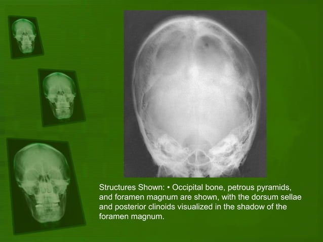 Positioning and radiographic anatomy of the skull | PPT | Bone and ...