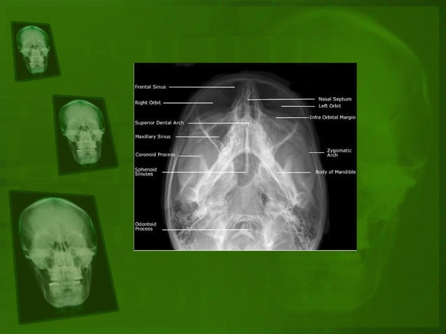 Positioning and radiographic anatomy of the skull | PPT | Bone and ...