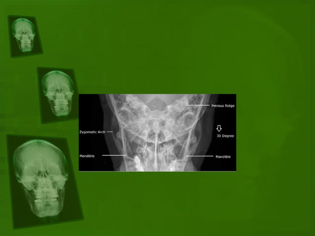Positioning and radiographic anatomy of the skull | PPT | Bone and ...