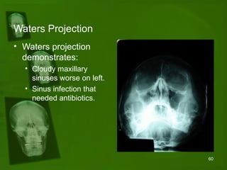 Positioning and radiographic anatomy of the skull | PPT