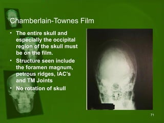 Positioning and radiographic anatomy of the skull | PPT