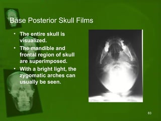 Submentovertical Zygomatic Arches