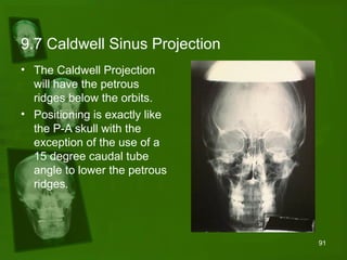 Positioning and radiographic anatomy of the skull | PPT