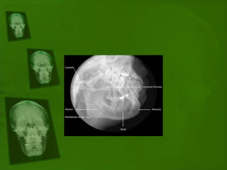 X Ray Of Skull