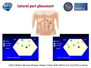 Positioning Ports for Robotic Partial Nephrectomy Challacombe | PPTX