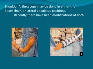 Positioning for shoulder arthroscopy | PPT