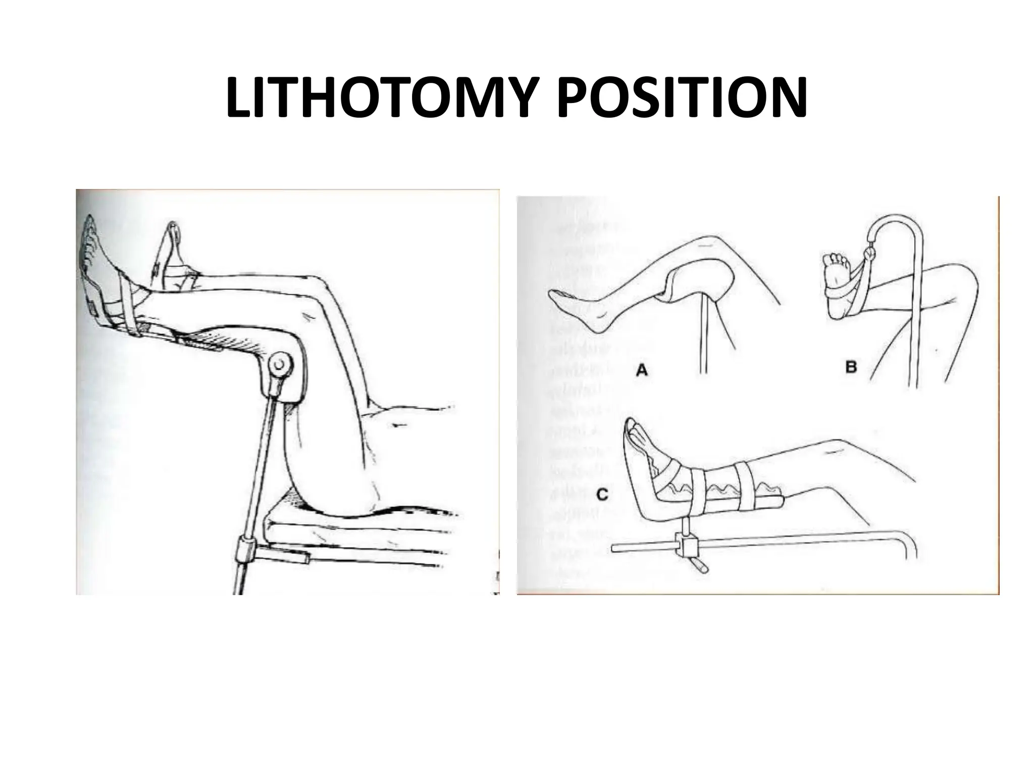 PATIENT POSITIONING AND ANAESTHESIA ppt | PPTX
