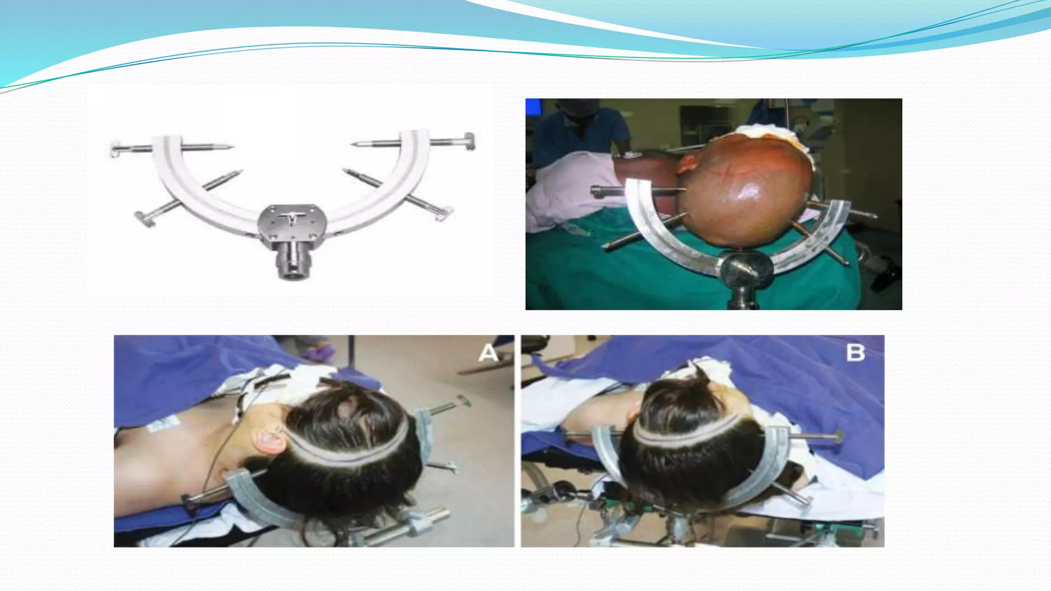 Positioning in neurosurgery | PPTX