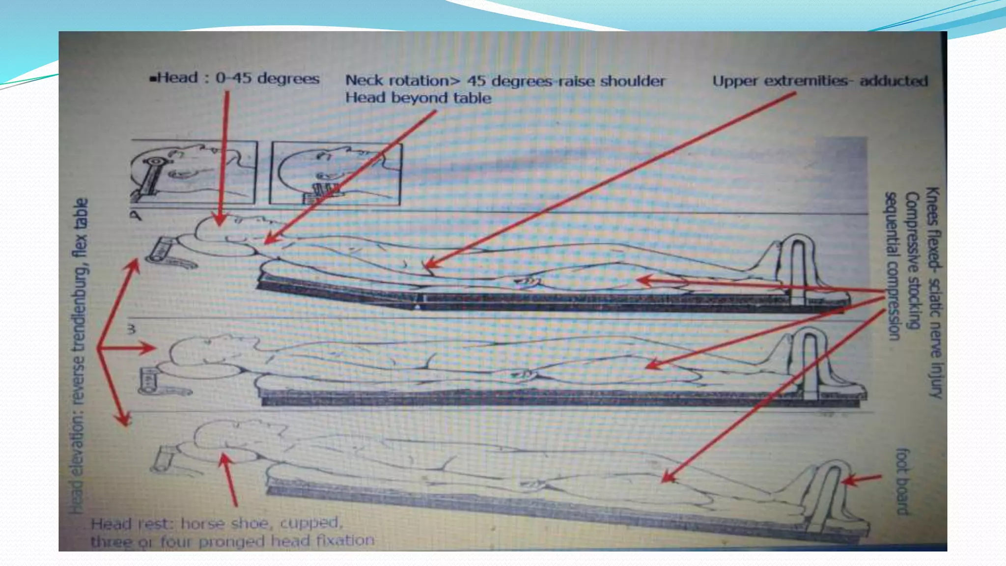 Positioning in neurosurgery | PPTX