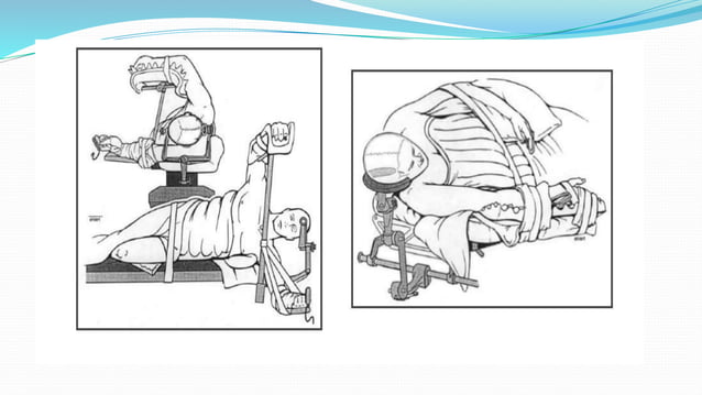 Positioning in neurosurgery | PPTX | Death, Injury, or Military ...