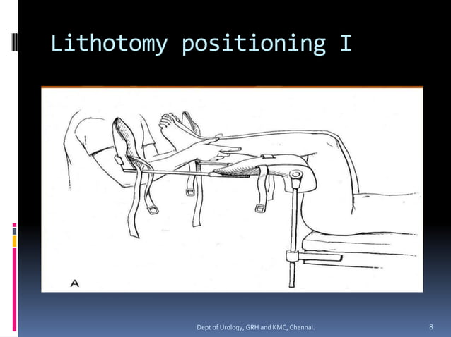 Positioning in urological procedures | PDF