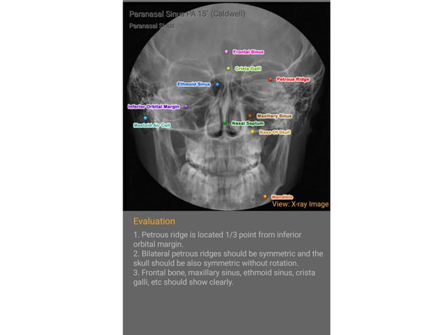 Positioning of Skull for X ray of PNS.pptx